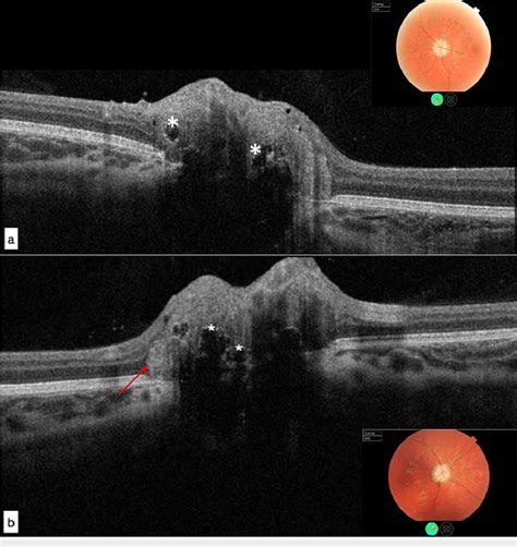 Papillary Oct Showing Numerous Small To Medium Sized Superficial Odds Download Scientific
