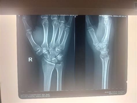 Carpometacarpal Joint Dislocation