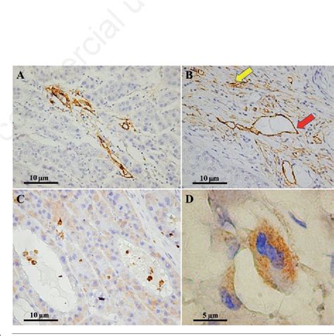 Figure 1 From The Multifaceted Role Of Podoplanin Expression In Hepatocellular Carcinoma