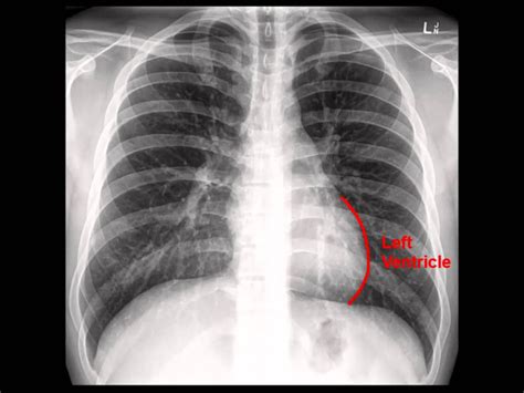 Pathology Videos Chest X Ray Analysis In A Nutshell