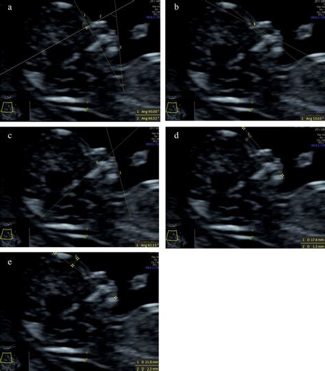 The Measurements Of Each Facial Marker Of Trisomy 18 Fetus 12w4d A Download Scientific