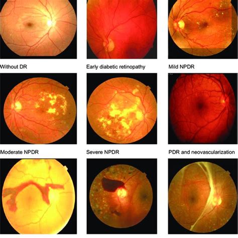 Pdf Diagnosis Of Diabetic Retinopathy Using Multi Level Set