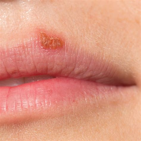 Cold Sores Symptoms Causes Treatment And More Wdgsg