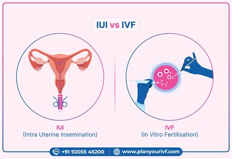 What Is Difference Between IVF And IUI Planyourivf