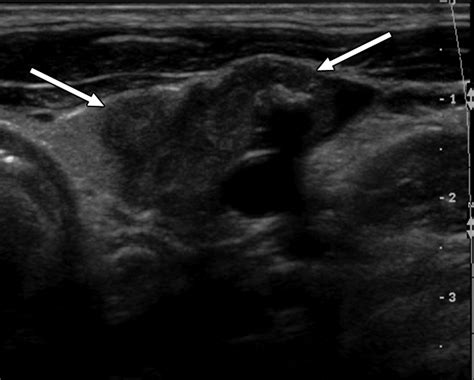 Thyroid Ultrasound