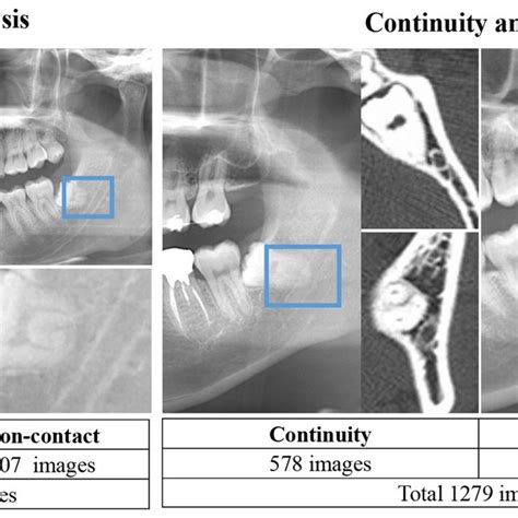 Classification Of The Relationship Between The Mandibular Third Molar