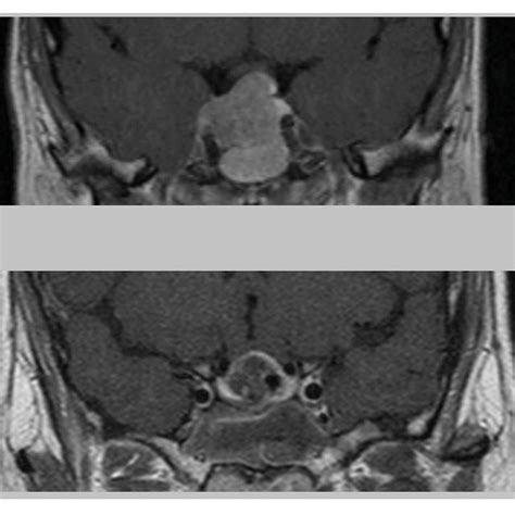 Non Functioning Pituitary Adenoma A And Hypophysitis B On Post Gd Download Scientific
