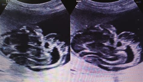 Longitudinal Ultrasonography Image Demonstrating Mantle Of Download Scientific Diagram