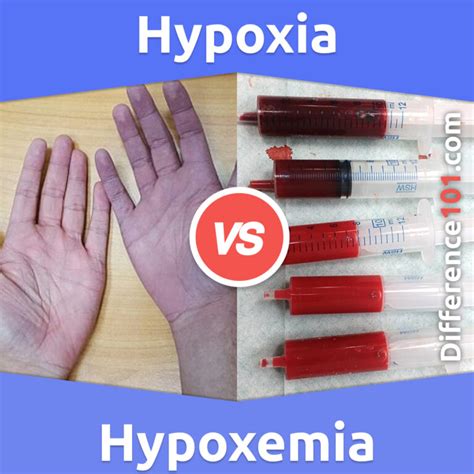 Hypoxia Vs Hypoxemia 5 Key Differences Pros And Cons Similarities
