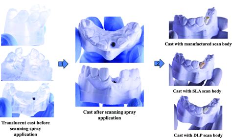 Simulated Dental Cast With Implants And Scan Bodies In Place Download Scientific Diagram