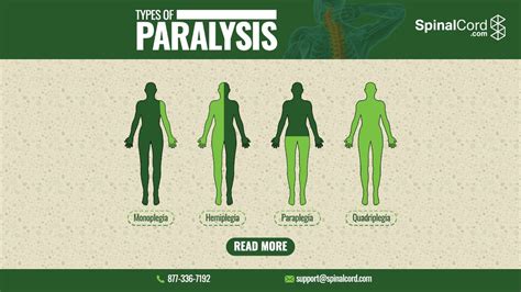 Paralysis Chart Familial Hyperkalemic Paralysis With Myotonia New