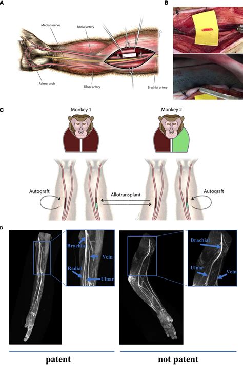 Major Histocompatibility Complex Matched Arteries Have Similar Patency