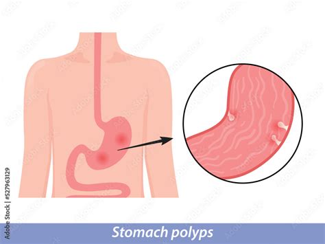 Stomach Polyps Diagnostic And Removal Endoscopy Procedure Concept Stock Vector Adobe Stock