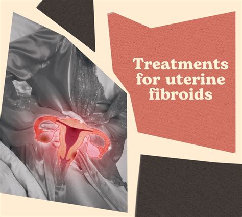 Uterine Fibroids Causes Symptoms And Treatment A Comprehensive
