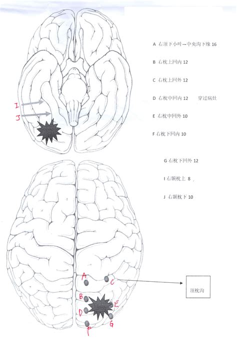 温医一院神经外科病例分享（20）：手术机器人辅助下利用立体定向脑电图seeg技术治疗难治性癫痫1例 脑医汇