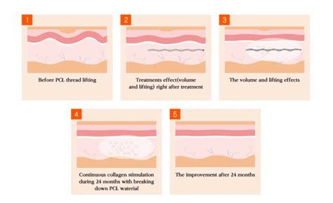 PDO Threads Are Here Laser Clear