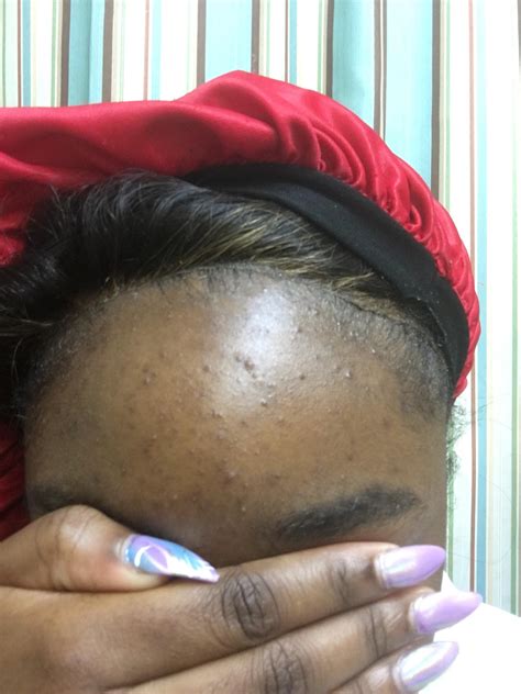 Why Do I Have These Fine Bumps On My Forehead And Hairline General Acne Discussion