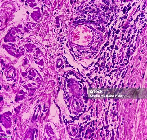 Kulit Preputial Peradangan Nonspesifik Kronis Dengan Displasia Mikroskopis Menunjukkan Kulit Preputial Peradangan Nonspesifik Kronis Dengan Displasia Mikroskopis Menunjukkan