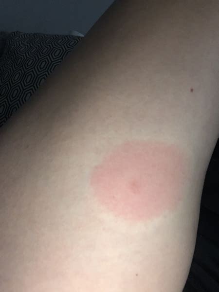 Bullseye Tick Bite Pics Tick Bite Rash Pictures Symptoms Causes And My Xxx Hot Girl