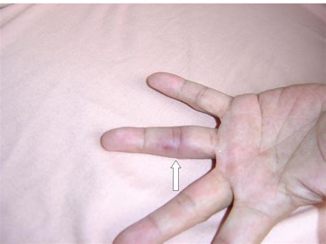 Osler Nodes Endocarditis