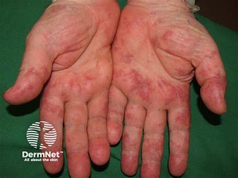 Hepatitis B Skin