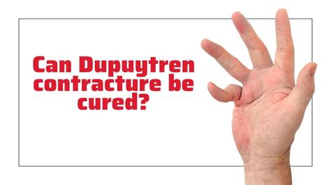 Xiaflex For Dupuytrens Contracture The Non Surgical Approach