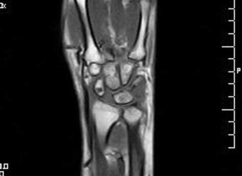 Scapholunate Dislocation Radiology Case Dislocation Radiology Dissociation