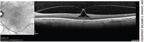 Managing Vitreomacular Traction Ophthalmology Management