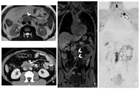 Testicular Cancer Lymph Nodes At Elaine Boehme Blog