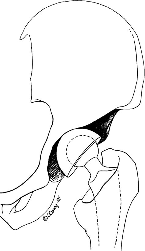 A Type Iii Uncontained Defect Involving Less Than 50 Of Acetabulum Is