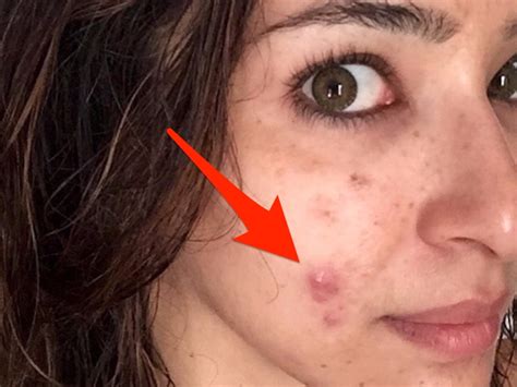 A Dermatologist Shared Photos Of Her Cystic Acne On Instagram Business Insider