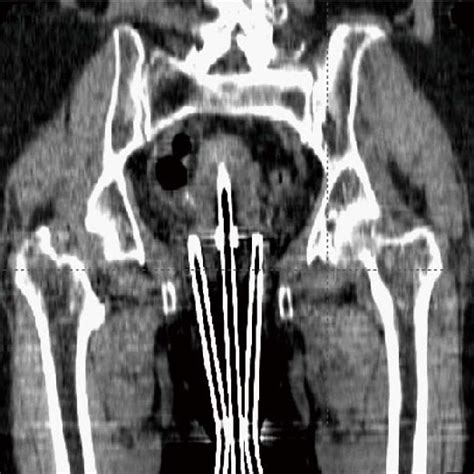 RTOG Scoring Criteria For Acute Radiation Skin Reactions Download Table