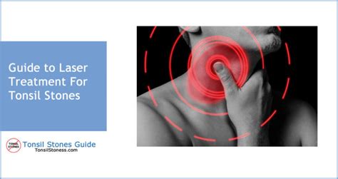 Guide To Laser Treatment For Tonsil Stones 2022