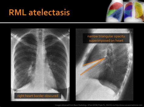Ppt Atelectasis Powerpoint Presentation Free Download Id6757762 Ppt Atelectasis Powerpoint Presentation Free Download Id6757762
