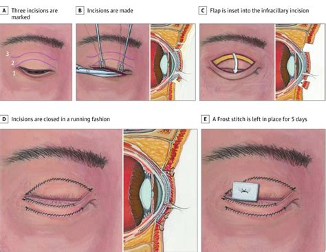 The Bipedicled Orbicularis Oculi Myocutaneous Flap For The Repair Of