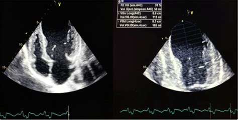 Echocardiography Imaging Displaying Severe Systolic Dysfunction Ef 31 Download Scientific