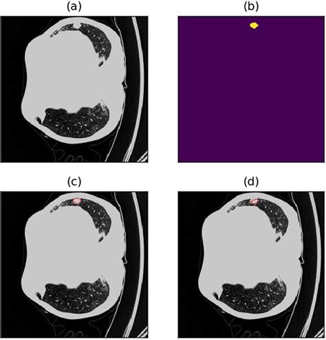 Figure 12 From Lung Nodule Segmentation Via Semi Residual Multi