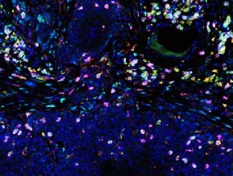 New Cancer Immunotherapy Target Male Sex Hormone