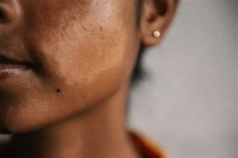 See The Effects Of Leprosy Leprosy Mission Australia