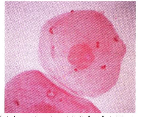 Figure 1 From Correlation Between Branhamella Catarrhalis Adherence To
