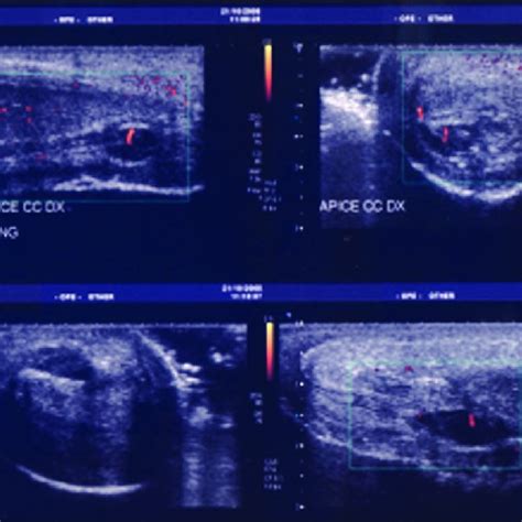 Penile Us Showing A Solid Hypoechoic Vascularized Lesion That Rises Download Scientific