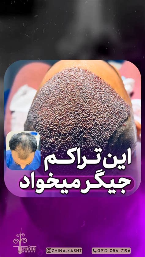 ‎کاشت ژینا زیر نظر پزشک متخصص پوست و مو‎ ‎ ️این حجم از تراکم اونم