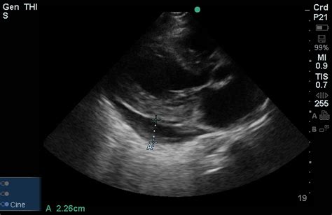 Differential Diagnosis Of Pericardial Effusion