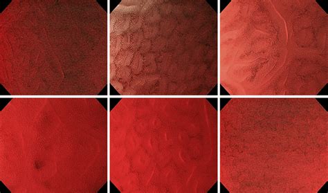 Images From 6 Cases Of Misdiagnosis Using Ec With Nbi The Irregular Mv Download Scientific