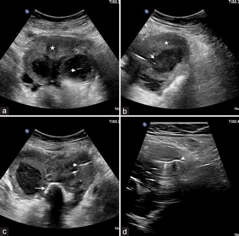 Diagnostic Dilemma Ovarian Dermoid Cysts Presenting With Uncommon