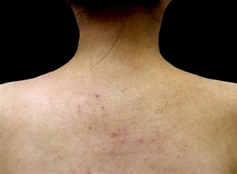 背中ニキビに洗い過ぎは要注意？キレイな背中になれるケア方法 Plathlone