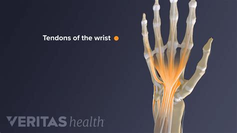 Wrist Tendonitis Vs Sprain