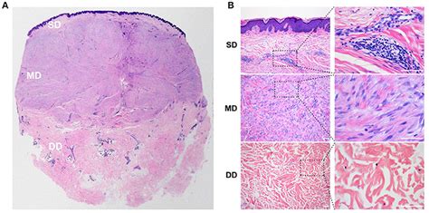 Frontiers The Superficial Dermis May Initiate Keloid Formation