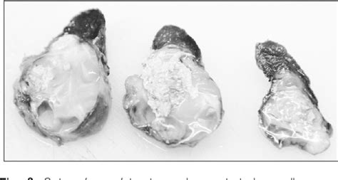 Figure 1 From A Case Of Teratoma Of Thyroid Gland In Adolescence