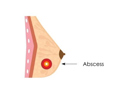 Breast Abscess Symptoms Causes Diagnosis Treatment